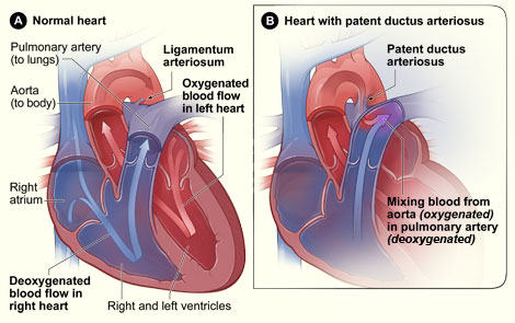 Patent Ductus Arteriosus | UCSF Department of Surgery
