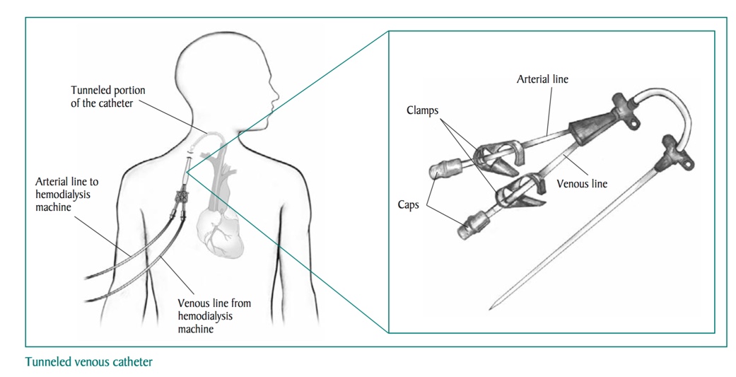 Vascular Access for Hemodialysis | UCSF Department of Surgery
